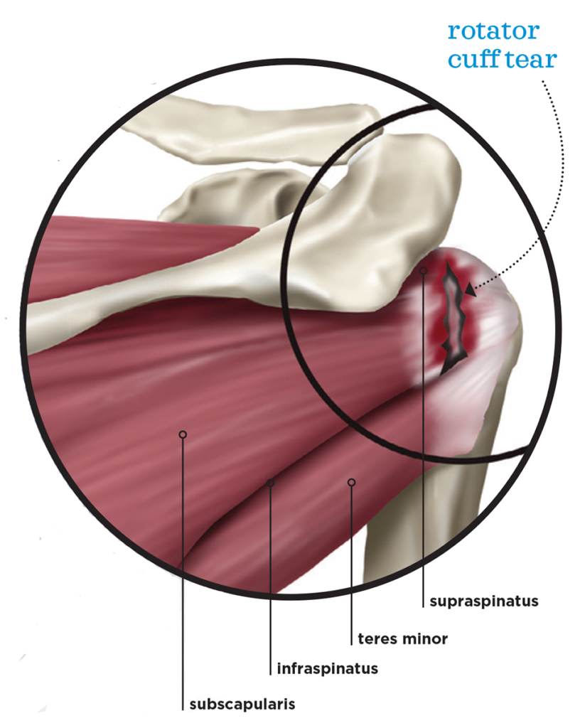 Rotator Cuff Anatomy - IDEA Health & Fitness Association